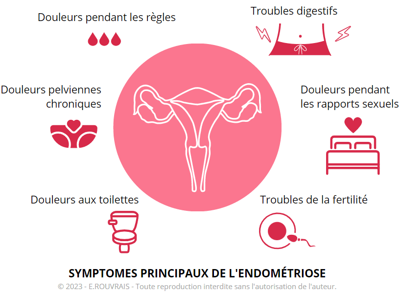 Endométriose : symptômes, traitements & RQTH